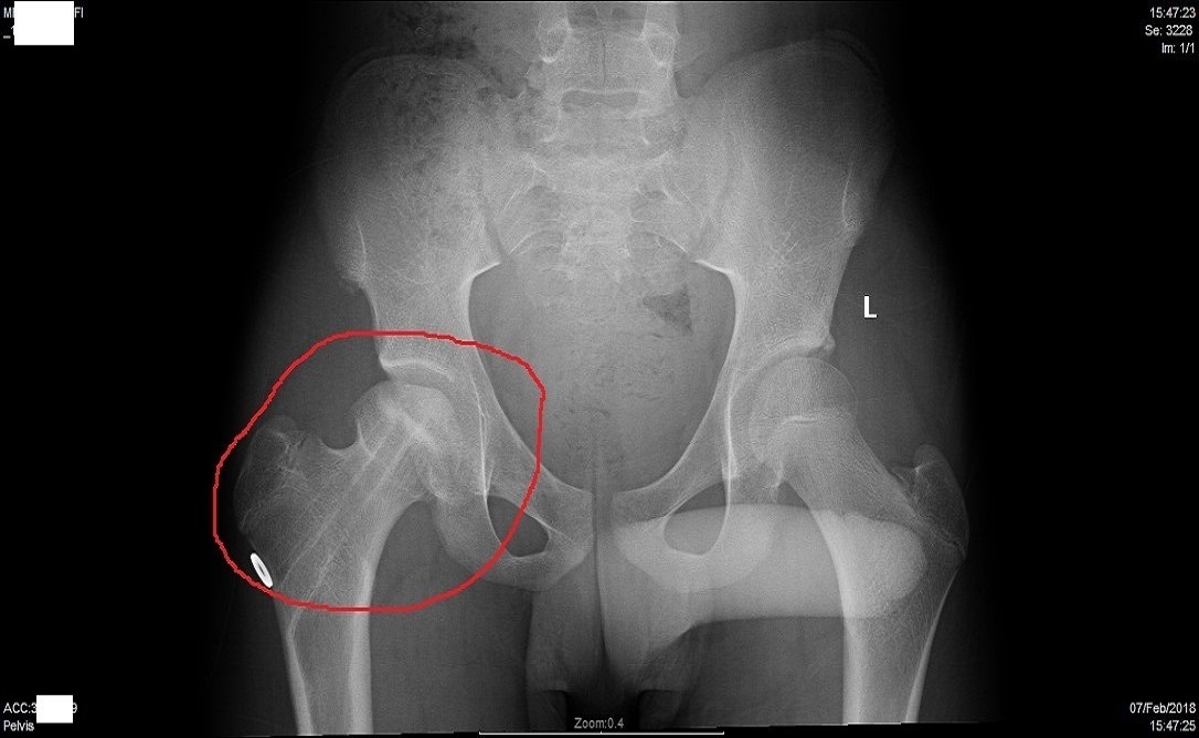 Hip Replacement Chinese Solution Hip Replacement Chinese Solution